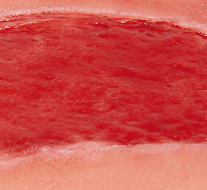 PW005B Wound Moulage Arterial Leg Ulcer, Large, Granulation Phase ...