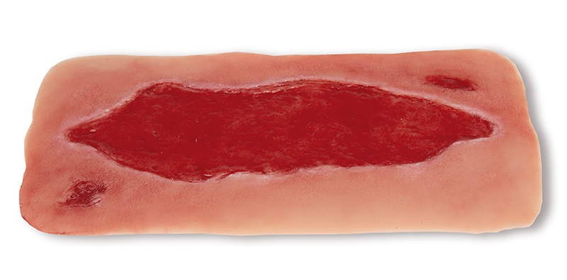 PW005B Wound Moulage Arterial Leg Ulcer, Large, Granulation Phase ...